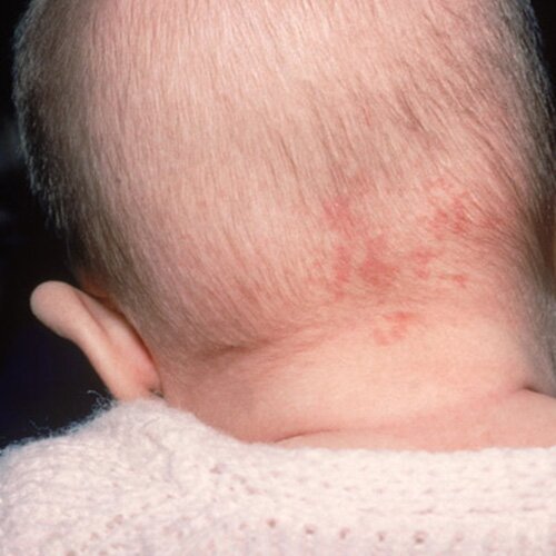 Red Rash On Back Of Baby S Head And Neck At Jai Reading Blog